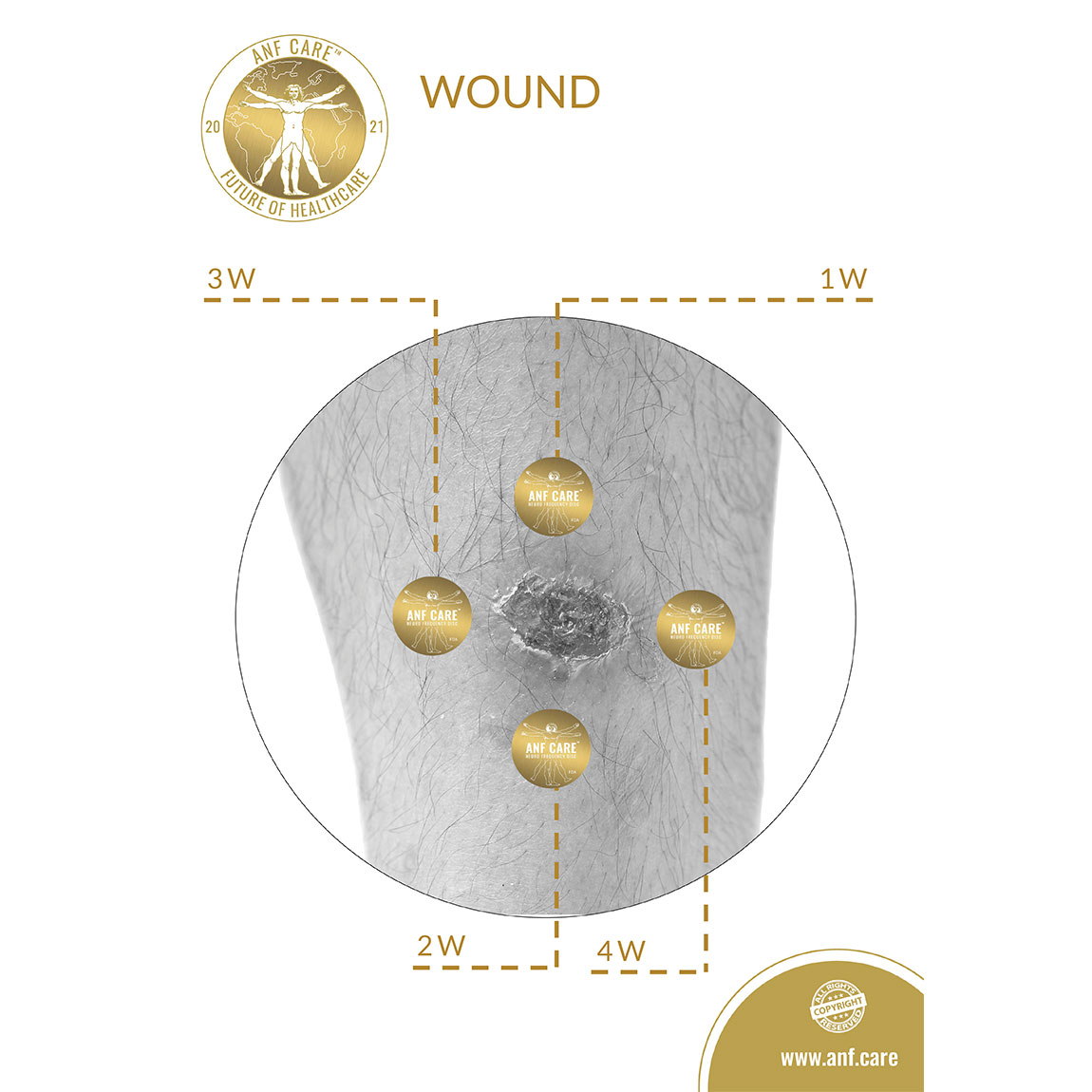 Wound - ANF Care